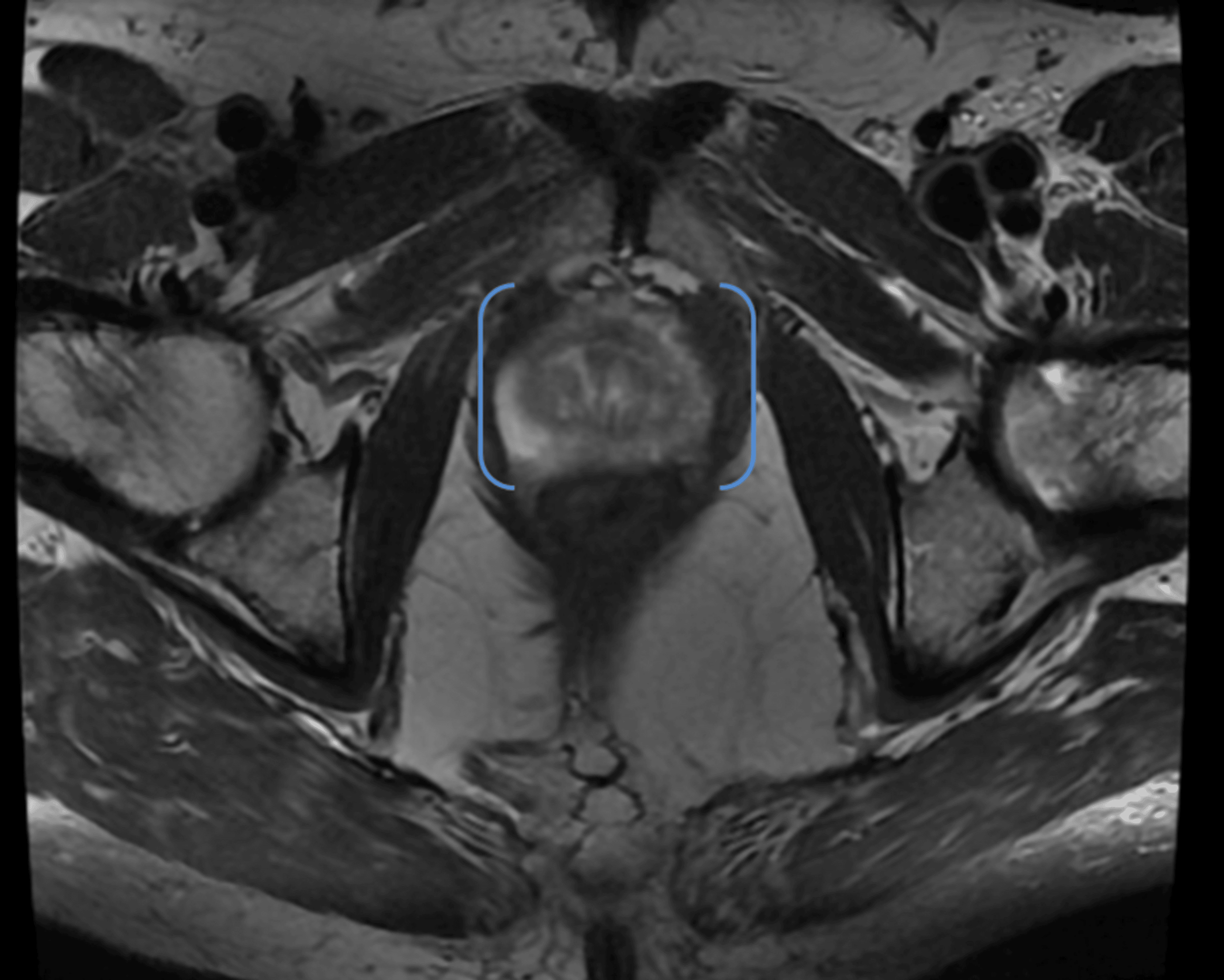 Prostatic Adenocarcinoma in a Patient With a History of Cryptorchidism ...