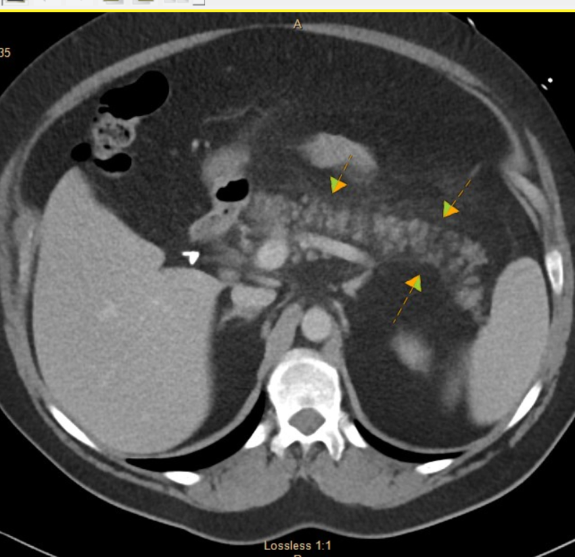 Cureus | Acute Pancreatitis Caused by Isotretinoin