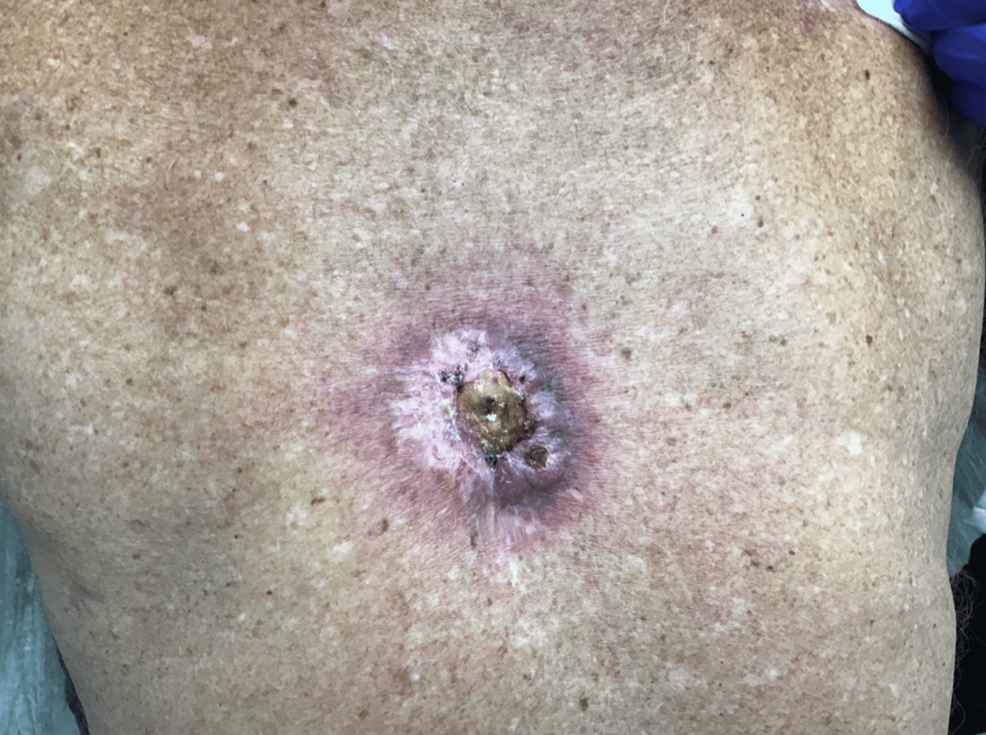 Cutaneous Squamous Cell Carcinoma Arising Within a Previously ...