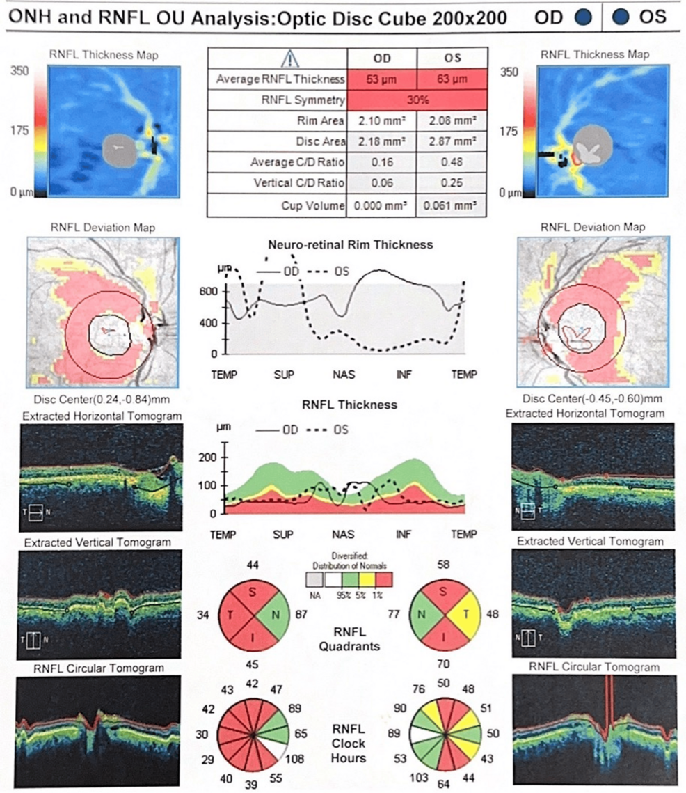 Linking Downbeat Nystagmus and Aquaporin-4-Positive Neuromyelitis ...