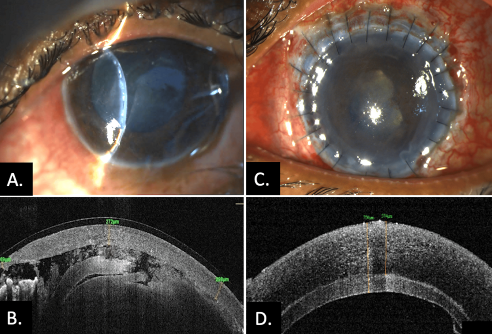 Abandoned Cataract Surgeries: An Analysis of Surgical Referrals to a ...