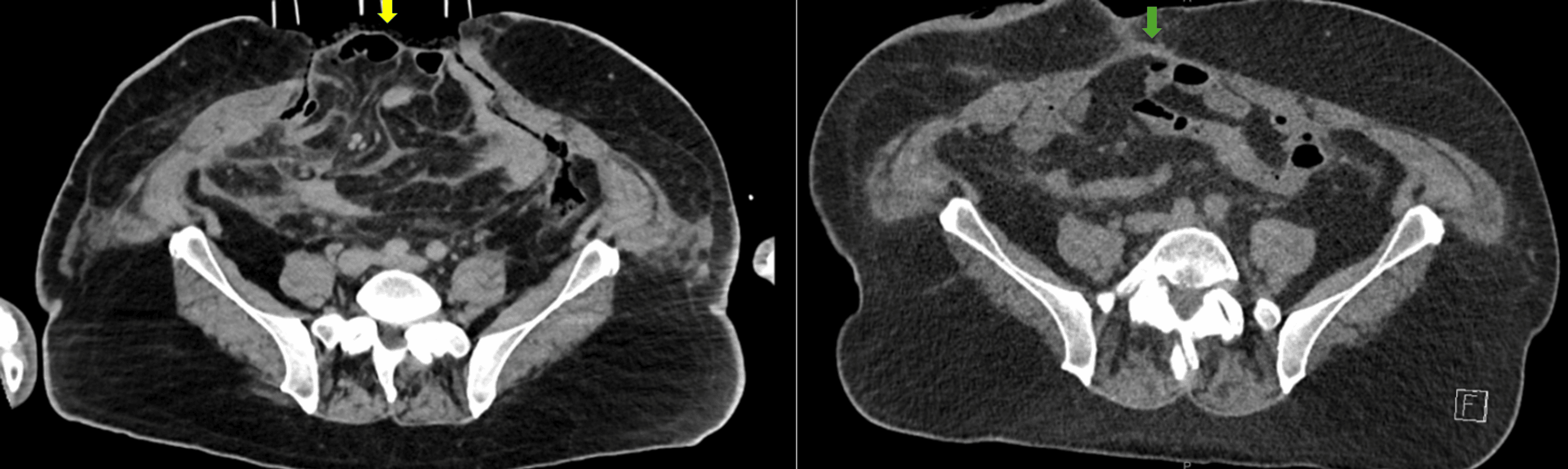 AbThera, Botox, and Fasciotens: A Trifecta in Open Abdomen Management ...