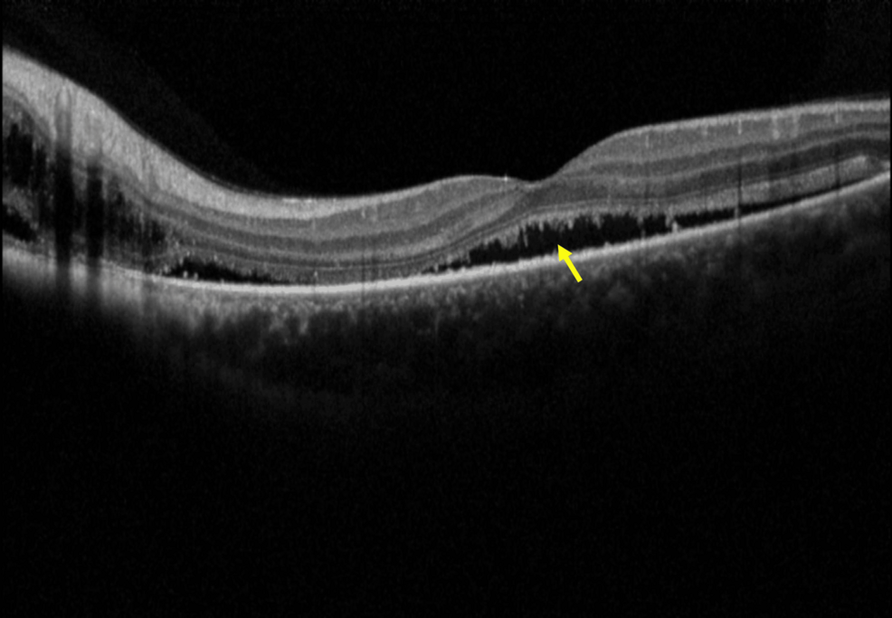 Malignant Transformation of a Choroidal Nevus | Cureus