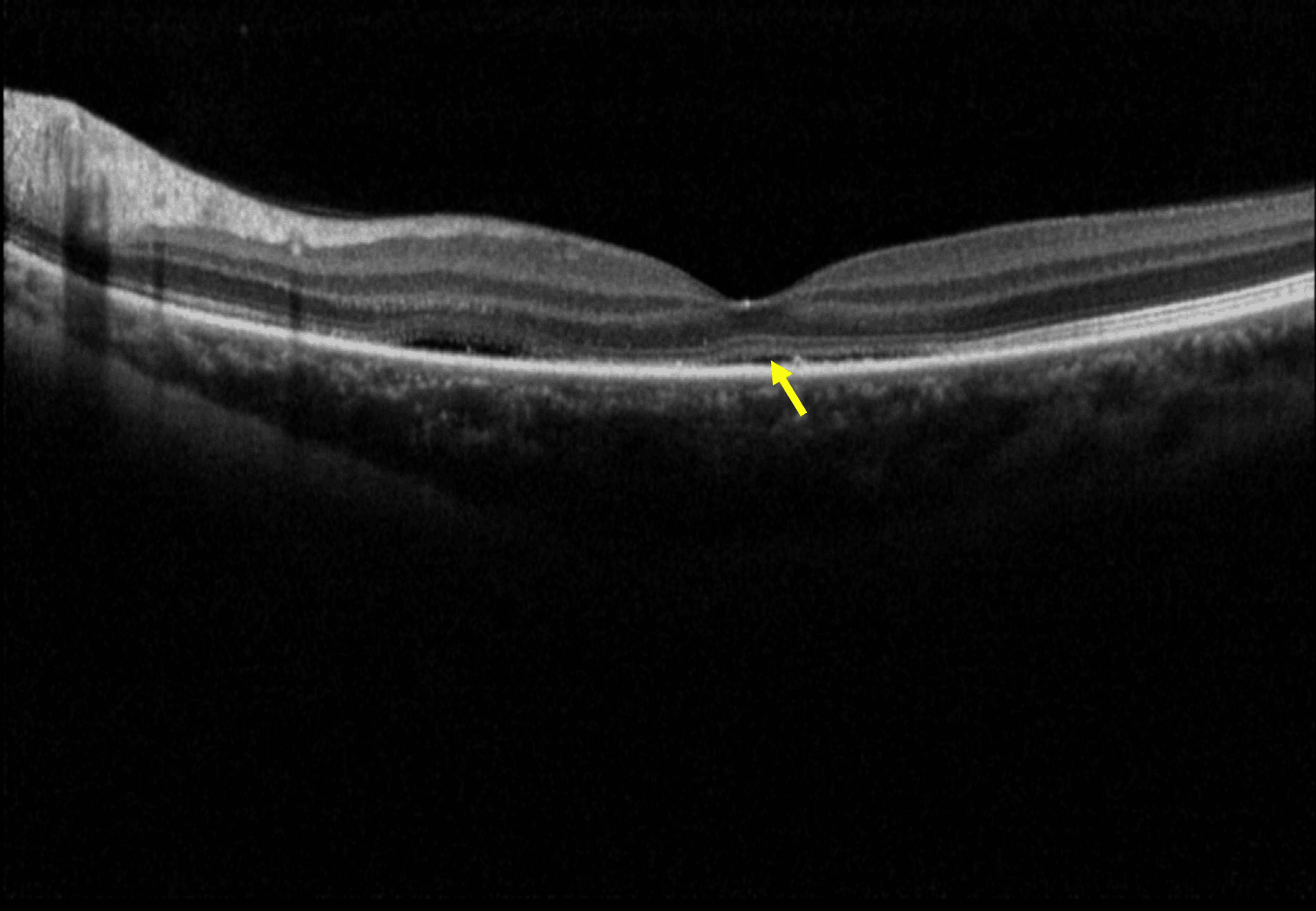 Malignant Transformation of a Choroidal Nevus | Cureus