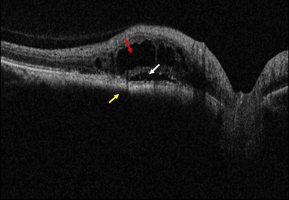 Malignant Transformation of a Choroidal Nevus | Cureus