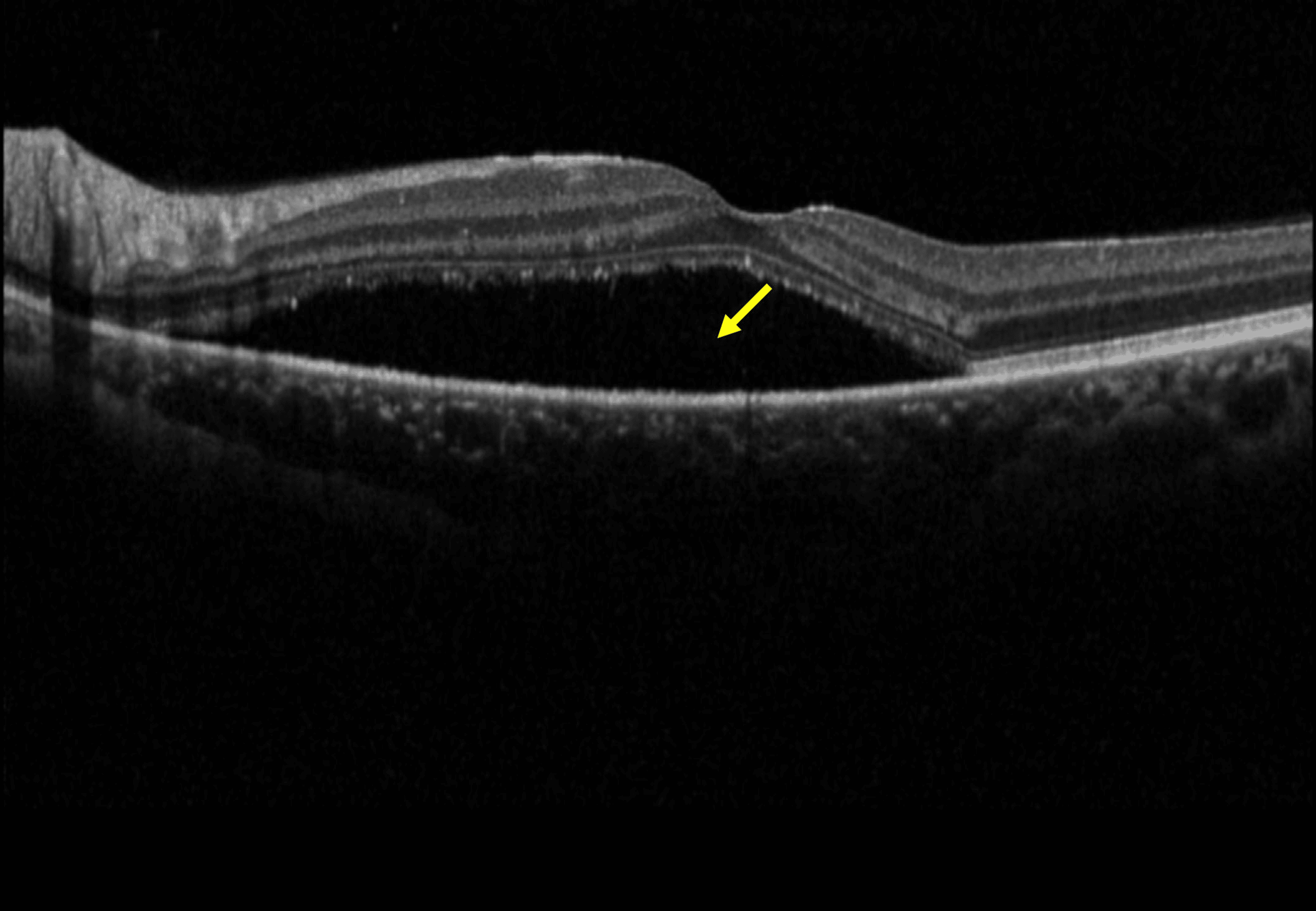 Malignant Transformation of a Choroidal Nevus | Cureus