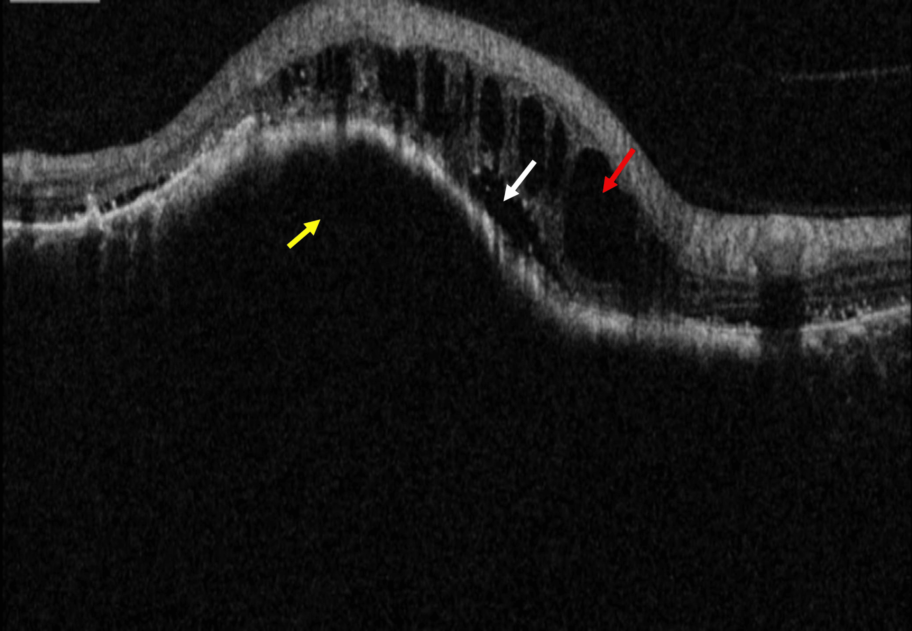 Malignant Transformation of a Choroidal Nevus | Cureus