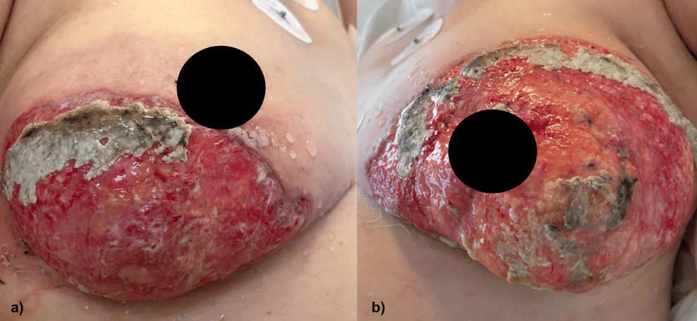 Pyoderma Gangrenosum Post Reduction Mammoplasty: An Unusual ...