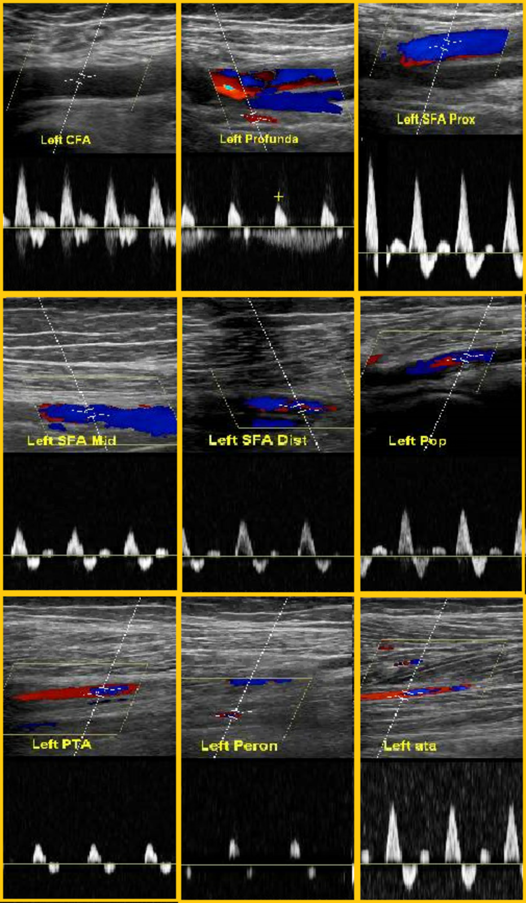 Lower Extremity Arterial Doppler Waveforms My XXX Hot Girl Lower Extremity Arterial Doppler Waveforms My XXX Hot Girl