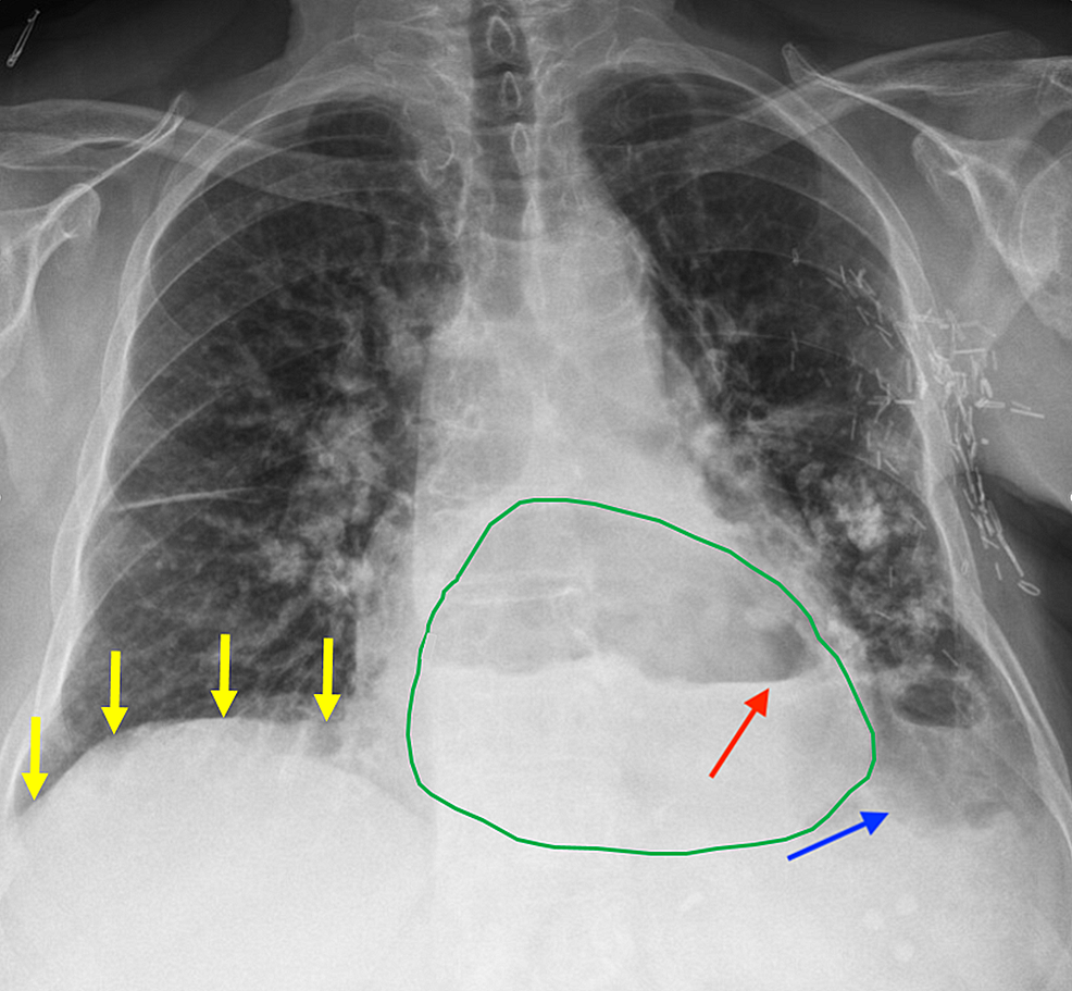 Cureus Minding The Gap Clinical Manifestations Of A Rare Type IV