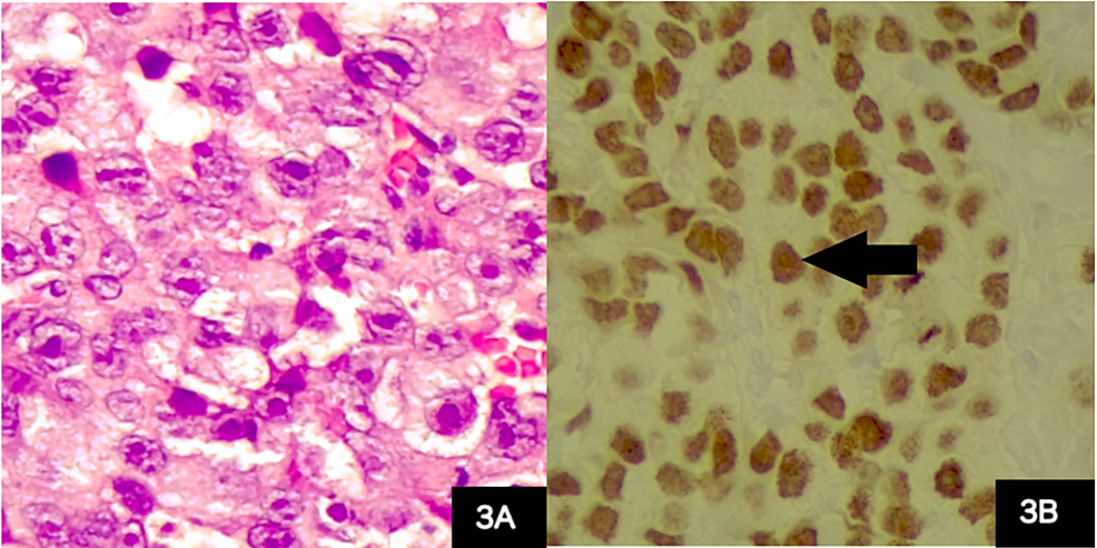 Cureus Unclassified Mixed Germ Cell Sex Cord Stromal Tumor Of The