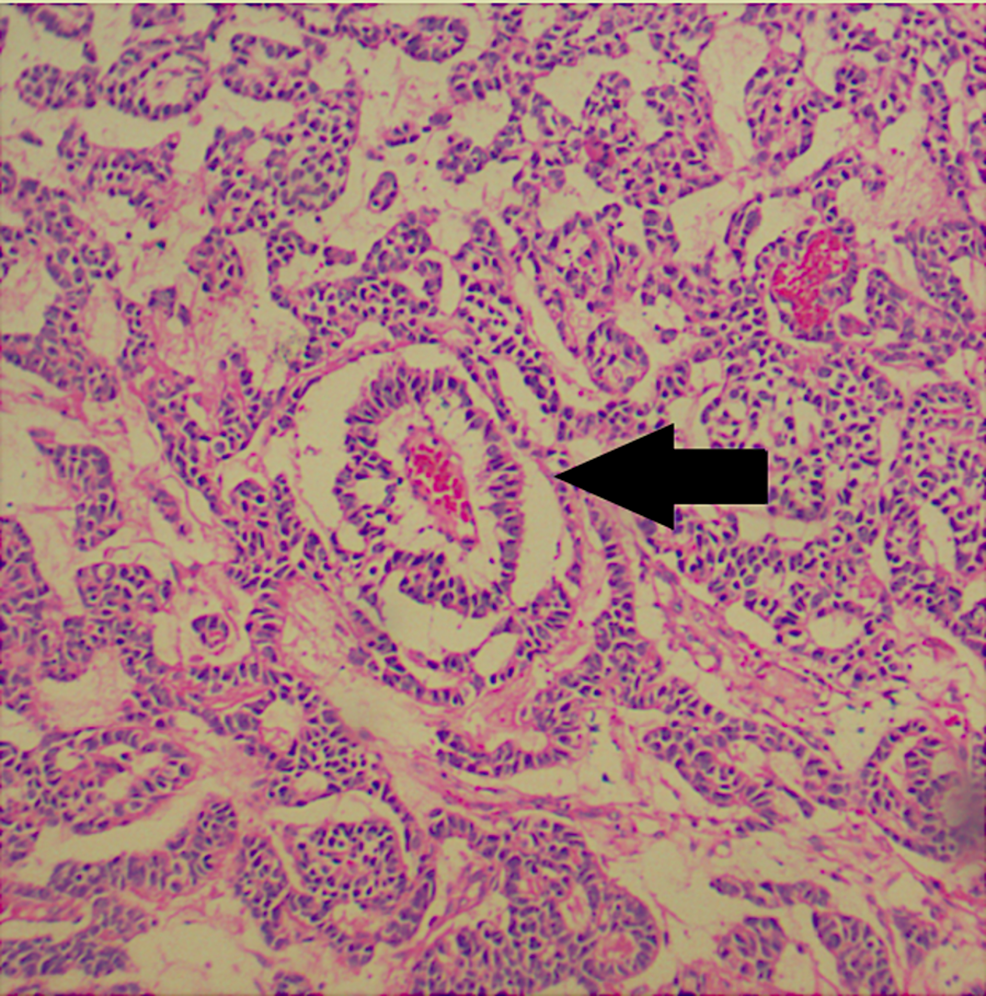 Cureus Unclassified Mixed Germ Cell Sex Cord Stromal Tumor Of The