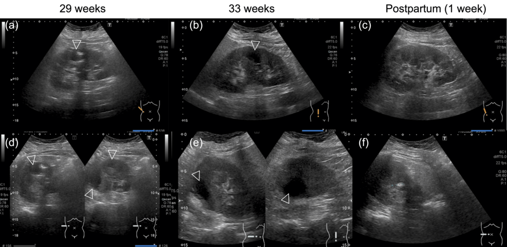 Emphysematous Pyelonephritis at 29 Weeks of Gestation: A Case Report ...