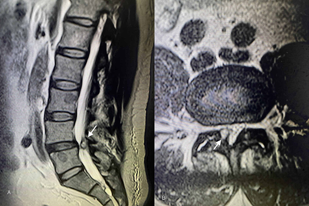 Cureus Lumbar Facet Joint Cyst Treated With Decompression And Cureus Lumbar Facet Joint Cyst Treated With Decompression And