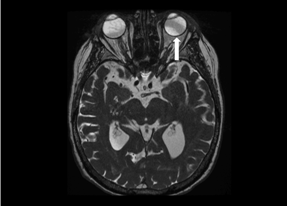 Vascular Loop Syndrome As the Etiology of Abducens Nerve Palsy: A Case ...