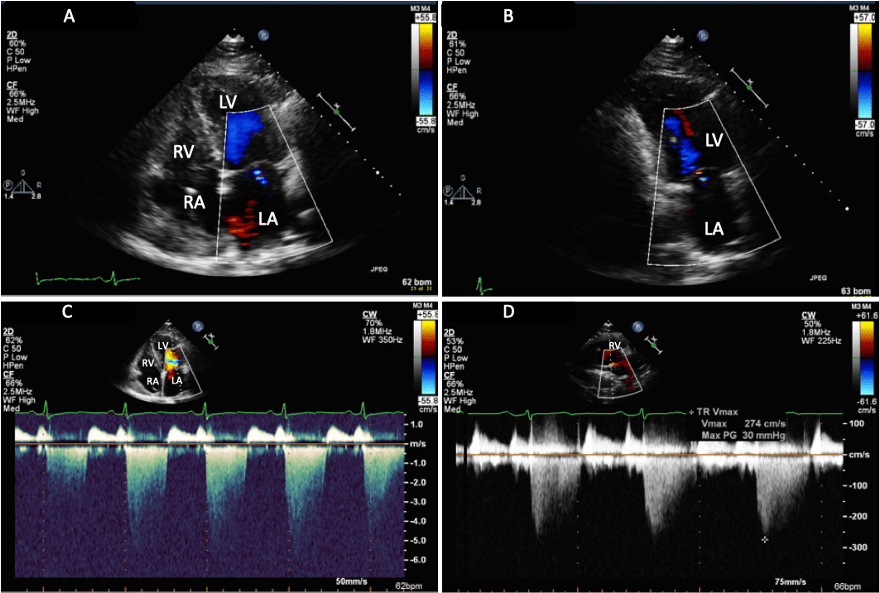A Case of Immediate Reduction of Severe Mitral Regurgitation After the ...
