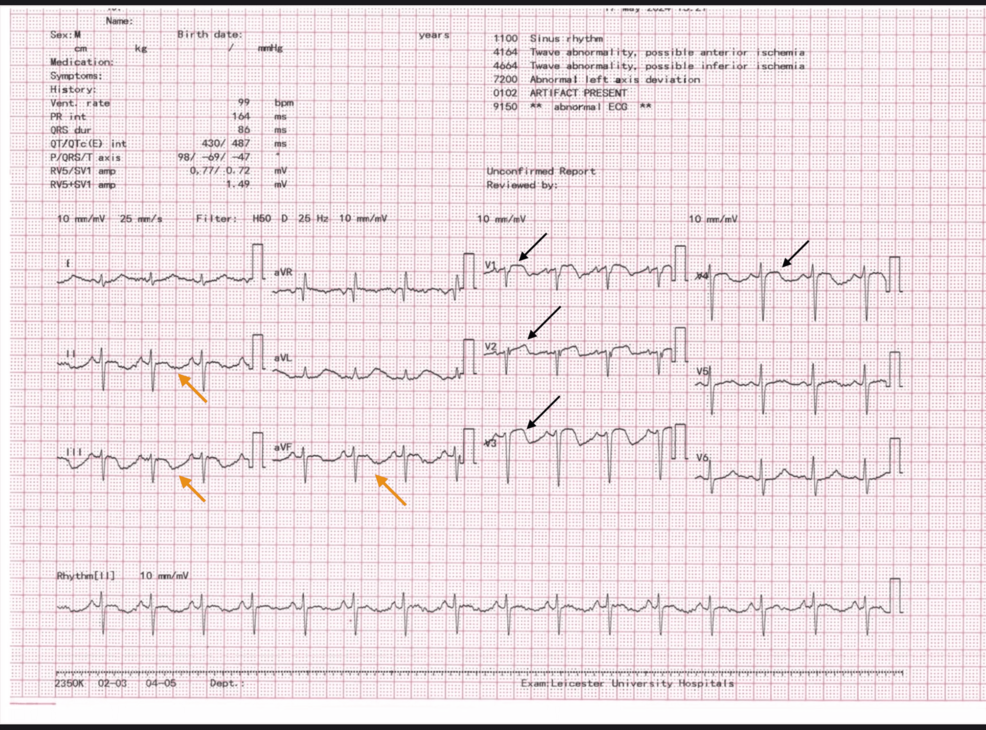 Stemi Vs Pericarditis Ecg