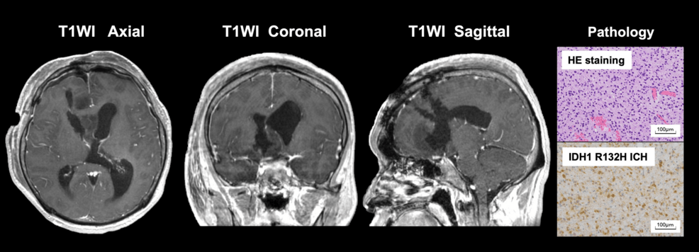 Diagnosis of Isocitrate Dehydrogenase-Mutant Astrocytoma in the ...
