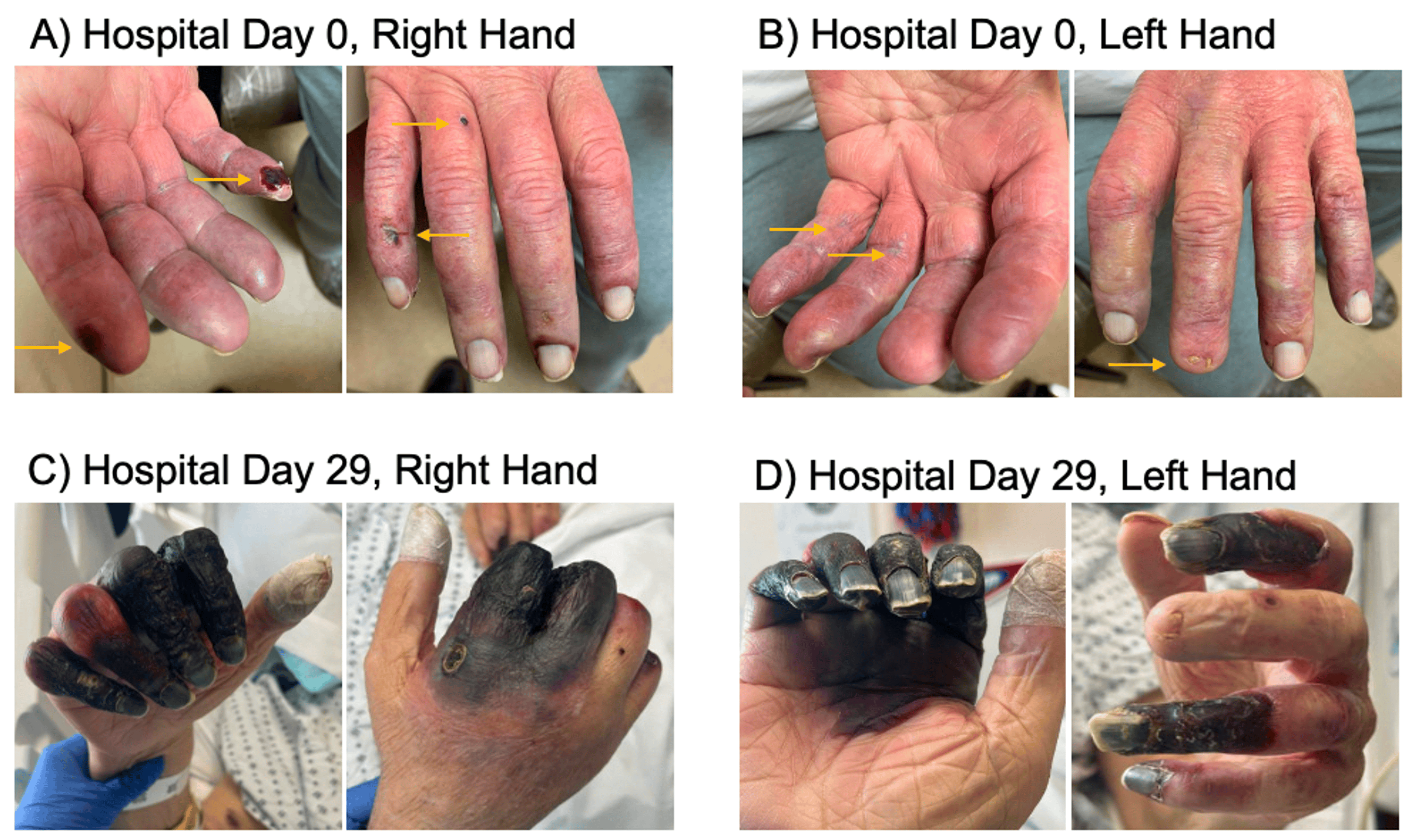 Progressive Cutaneous Cholesterol Emboli Syndrome | Cureus