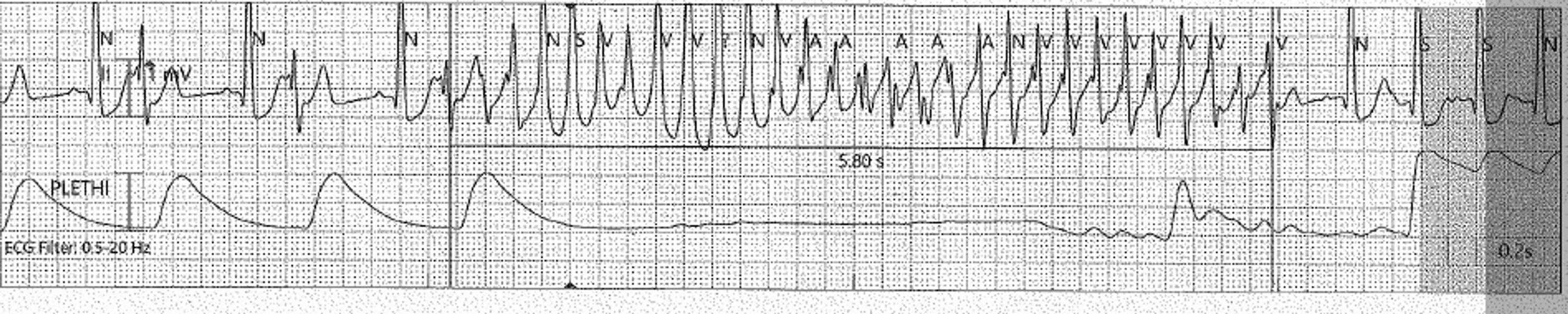 Exceptional Seizure-Like Presentation of Torsades De Pointes | Cureus