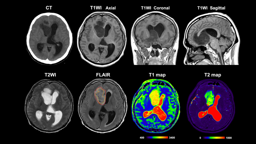 Diagnosis of Isocitrate Dehydrogenase-Mutant Astrocytoma in the ...
