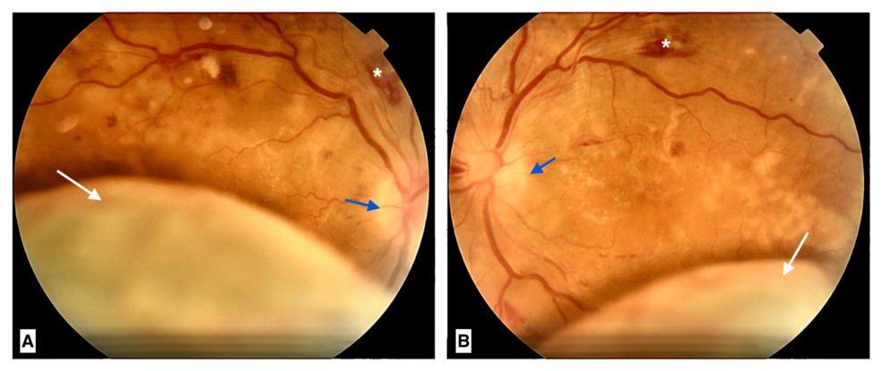Massive Bilateral Exudative Retinal Detachment Revealing ...