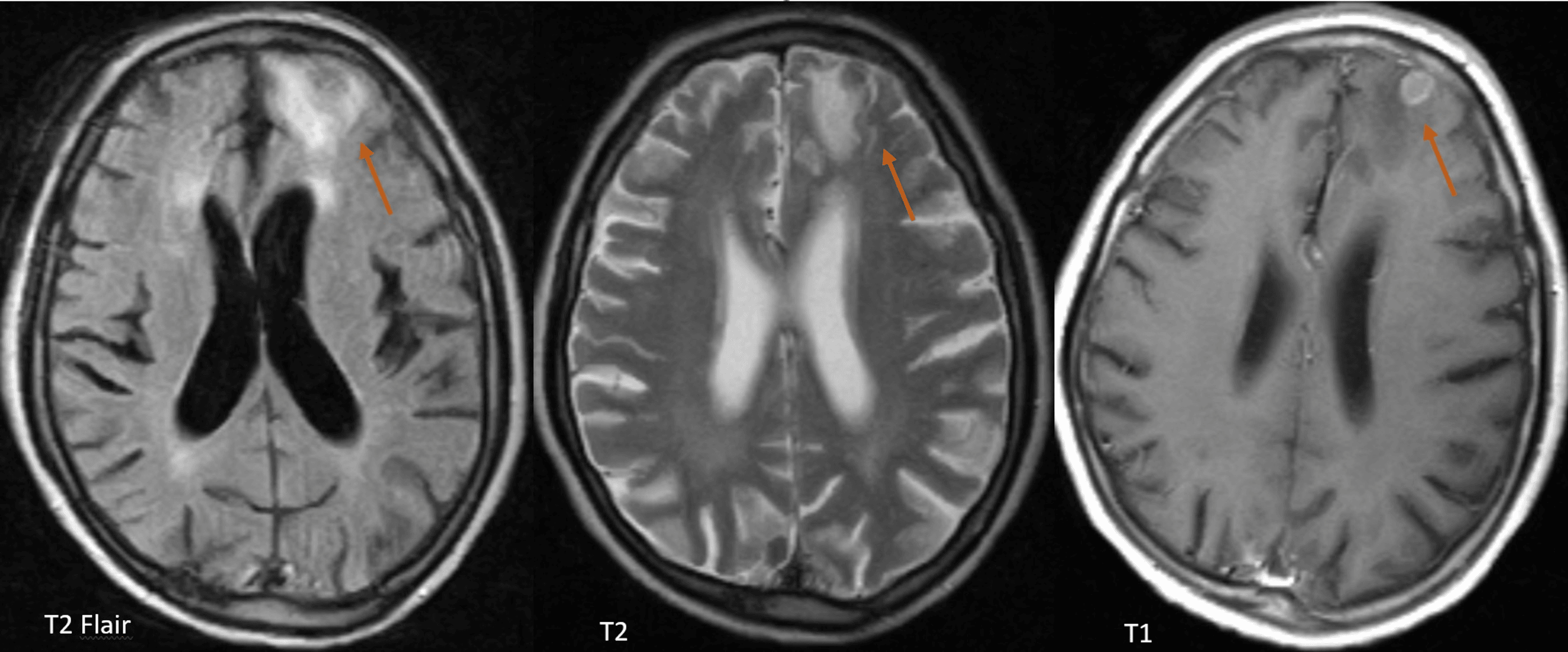 The Pathological Fear of COVID-19 and Neuroparasitosis: A Case Report ...