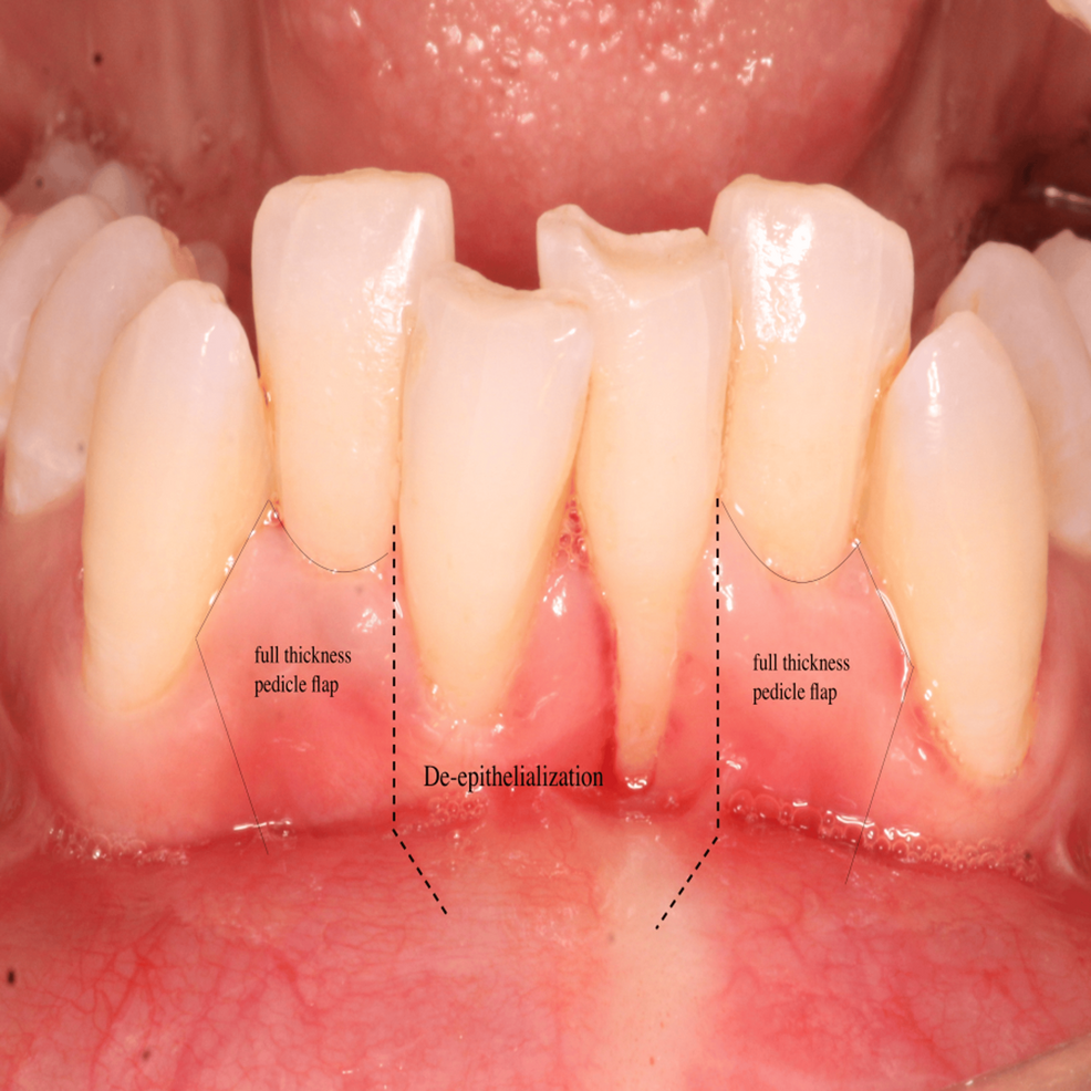 Double Pedicle Approach for the Management of Gingival Recession in ...