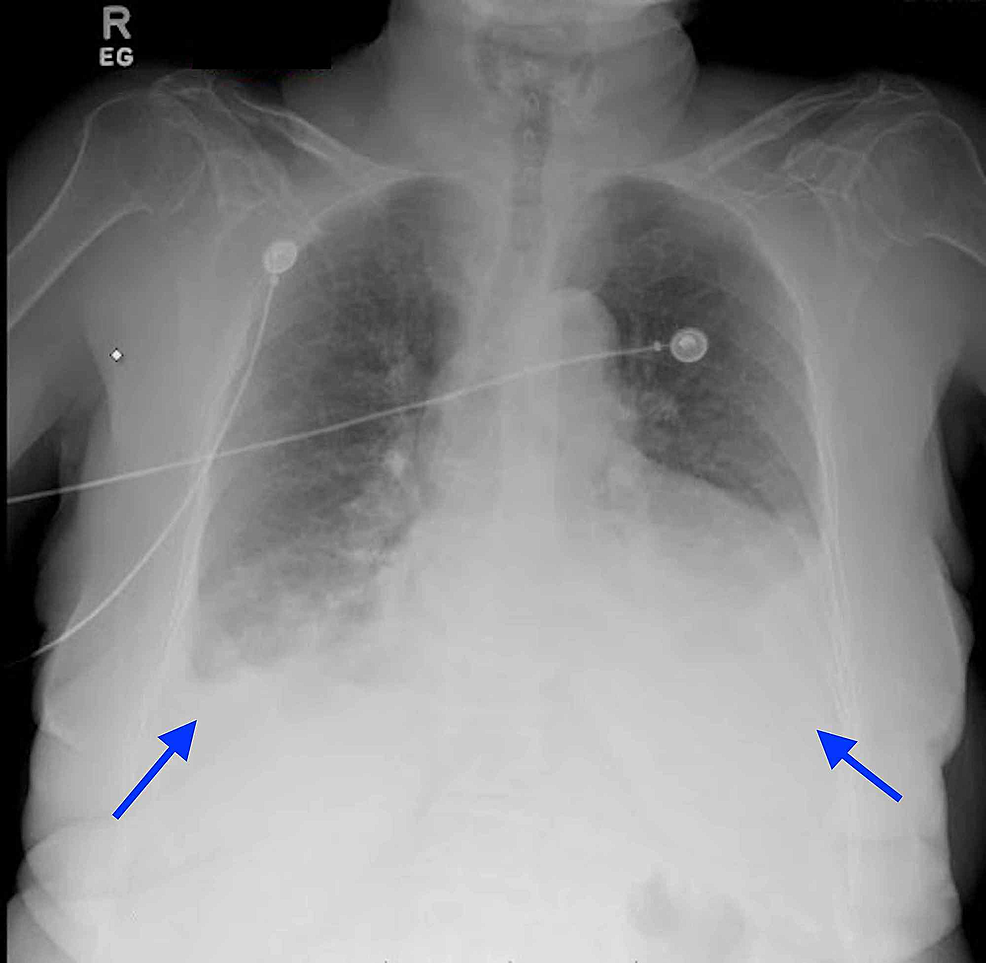 Cureus A Case Of Seronegative ANA Hydralazine Induced Lupus Cureus A Case Of Seronegative ANA Hydralazine Induced Lupus