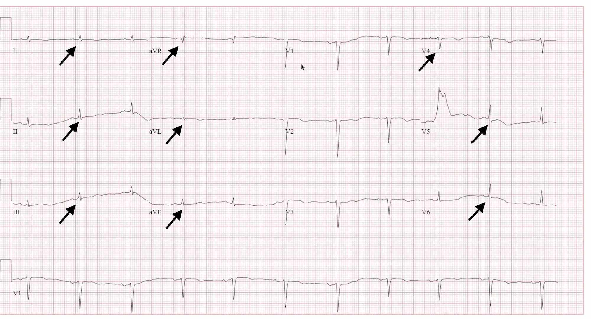 Ecg Pvcs Multifocal Ventricular Atrial Isolated Single Sinus Row Index ...