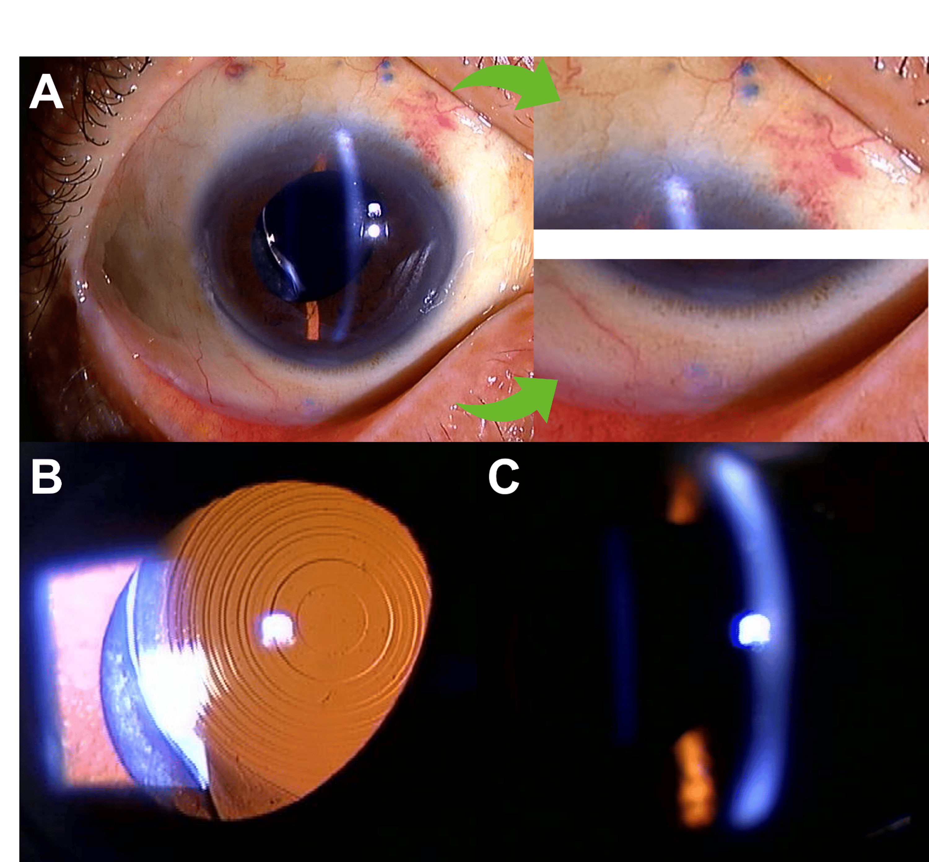 Re-fixation Using the Belt Loop Technique for Postoperative Subluxation ...