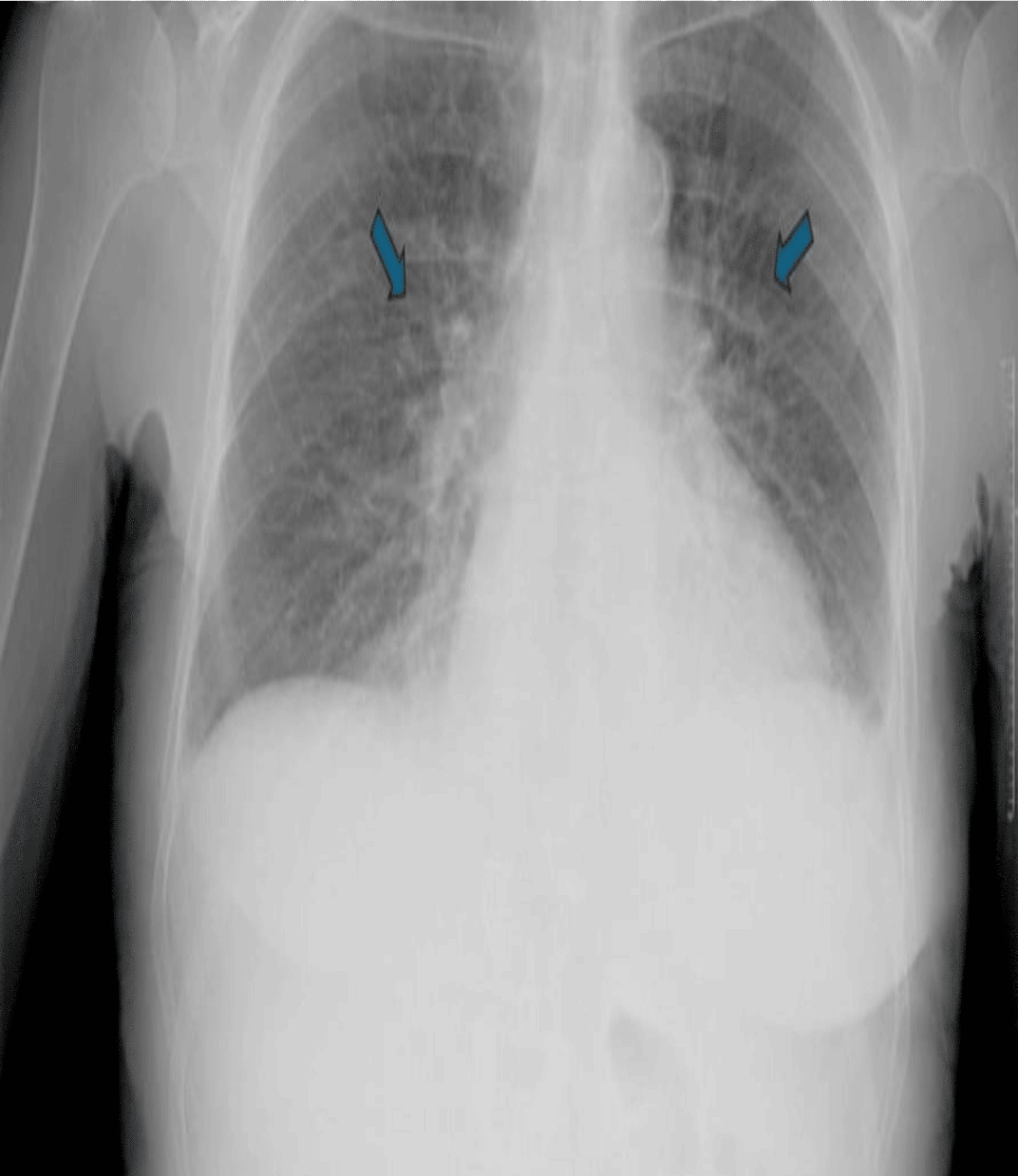 Revealing the Intersection: Scleroderma Renal Crisis Complicating ...