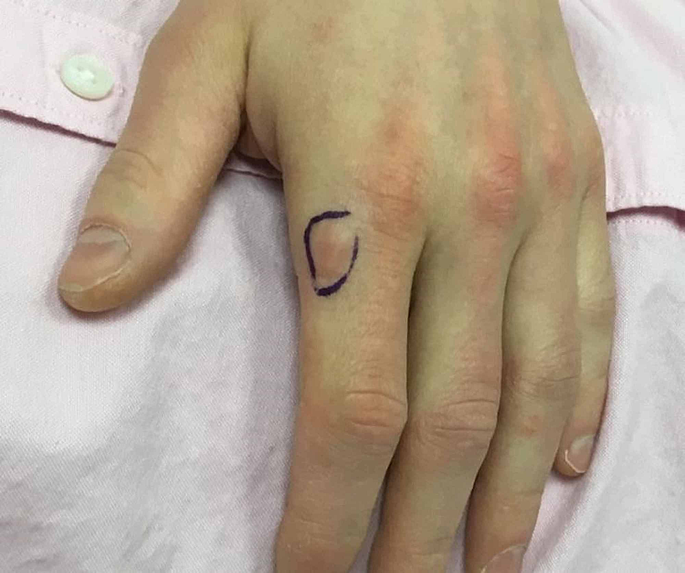 Cureus Firm Cutaneous Nodule On The Dorsal Hand A Case Report On Cureus Firm Cutaneous Nodule On The Dorsal Hand A Case Report On
