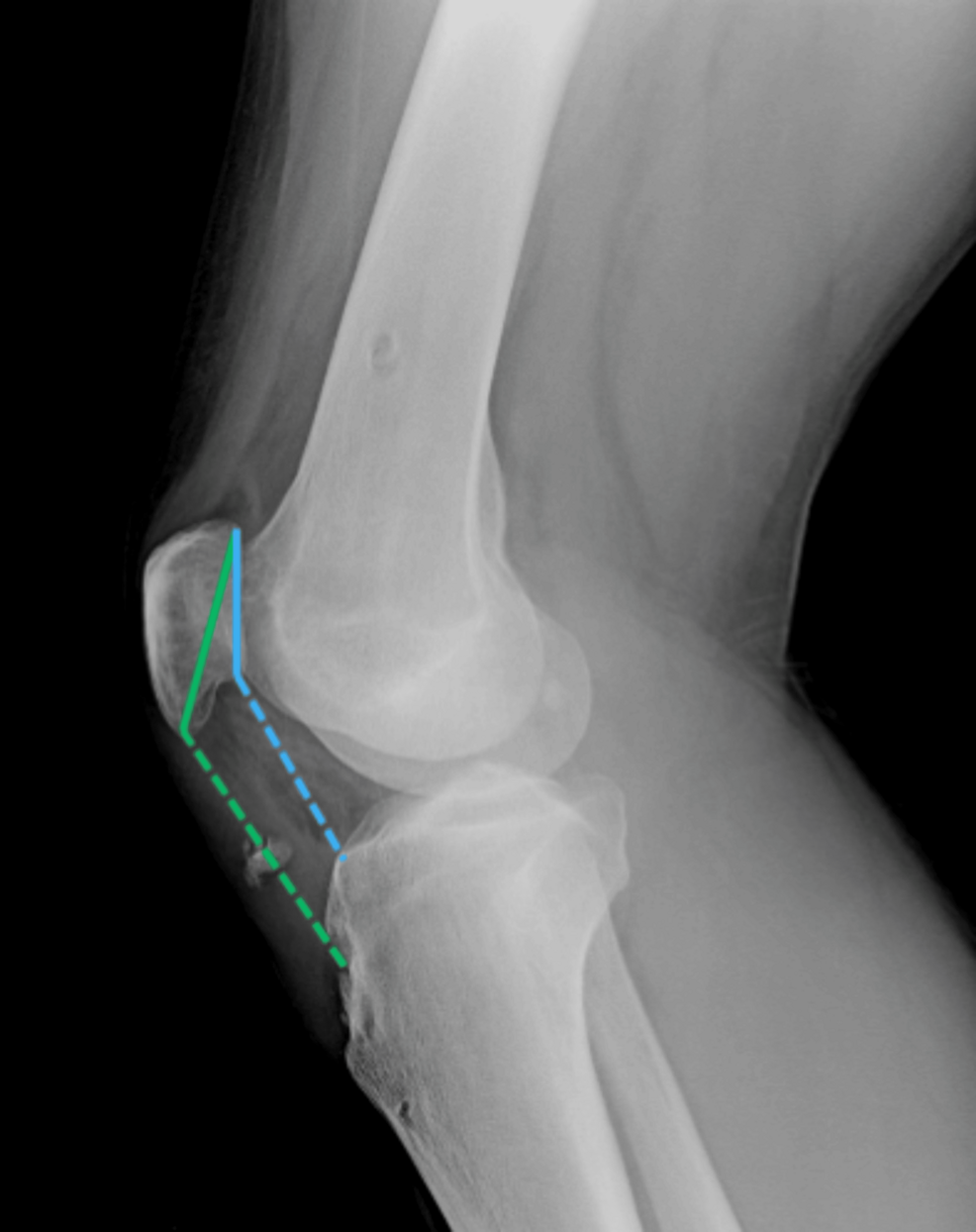 Neglected Patellar Tendon Rupture Treated With a Single Semitendinosus ...