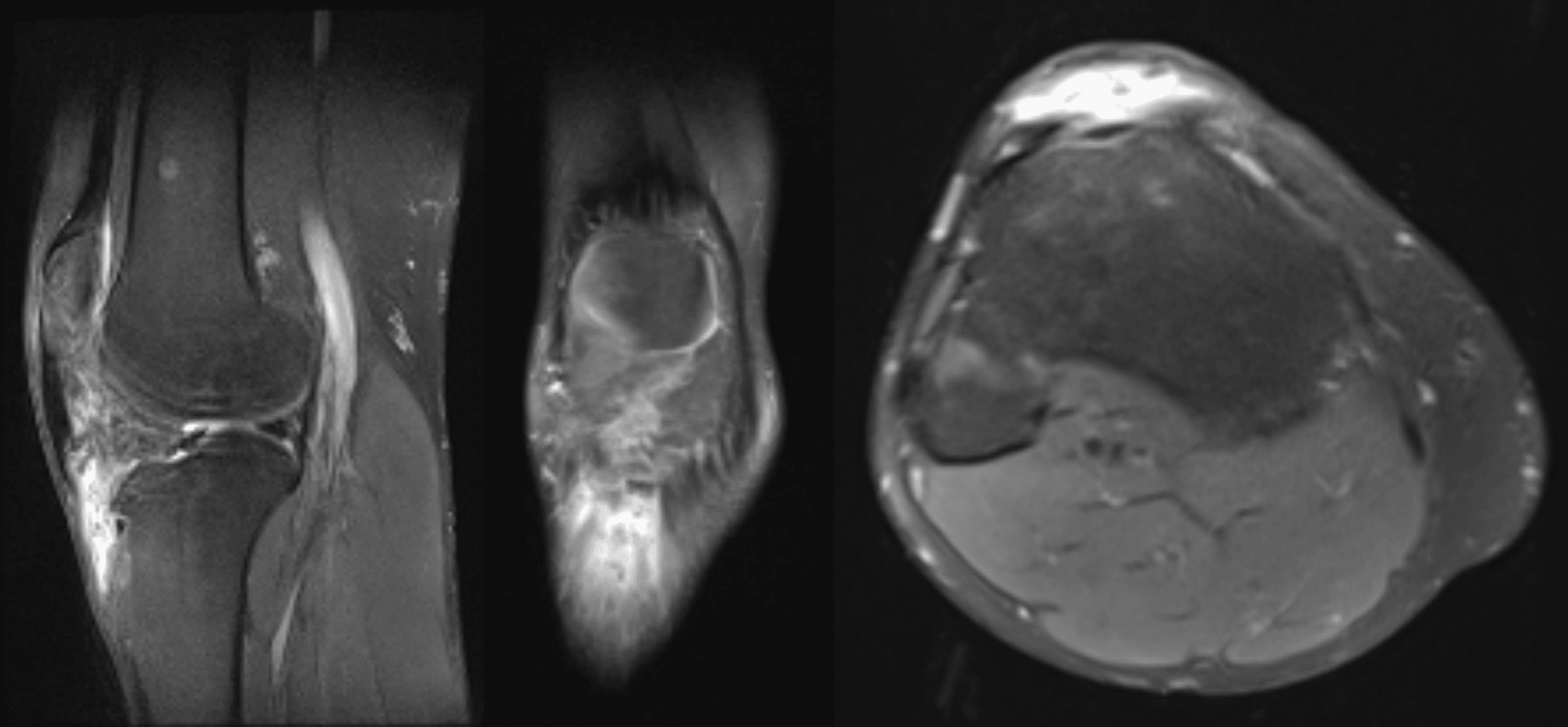 Neglected Patellar Tendon Rupture Treated With a Single Semitendinosus ...