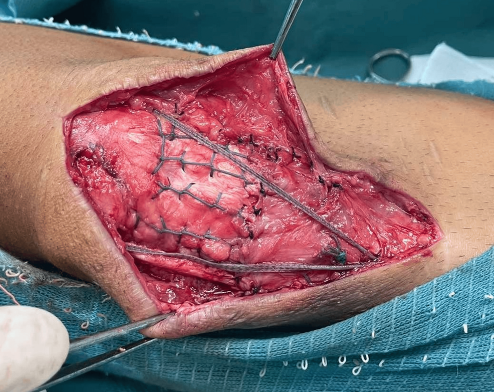 Neglected Patellar Tendon Rupture Treated With a Single Semitendinosus ...