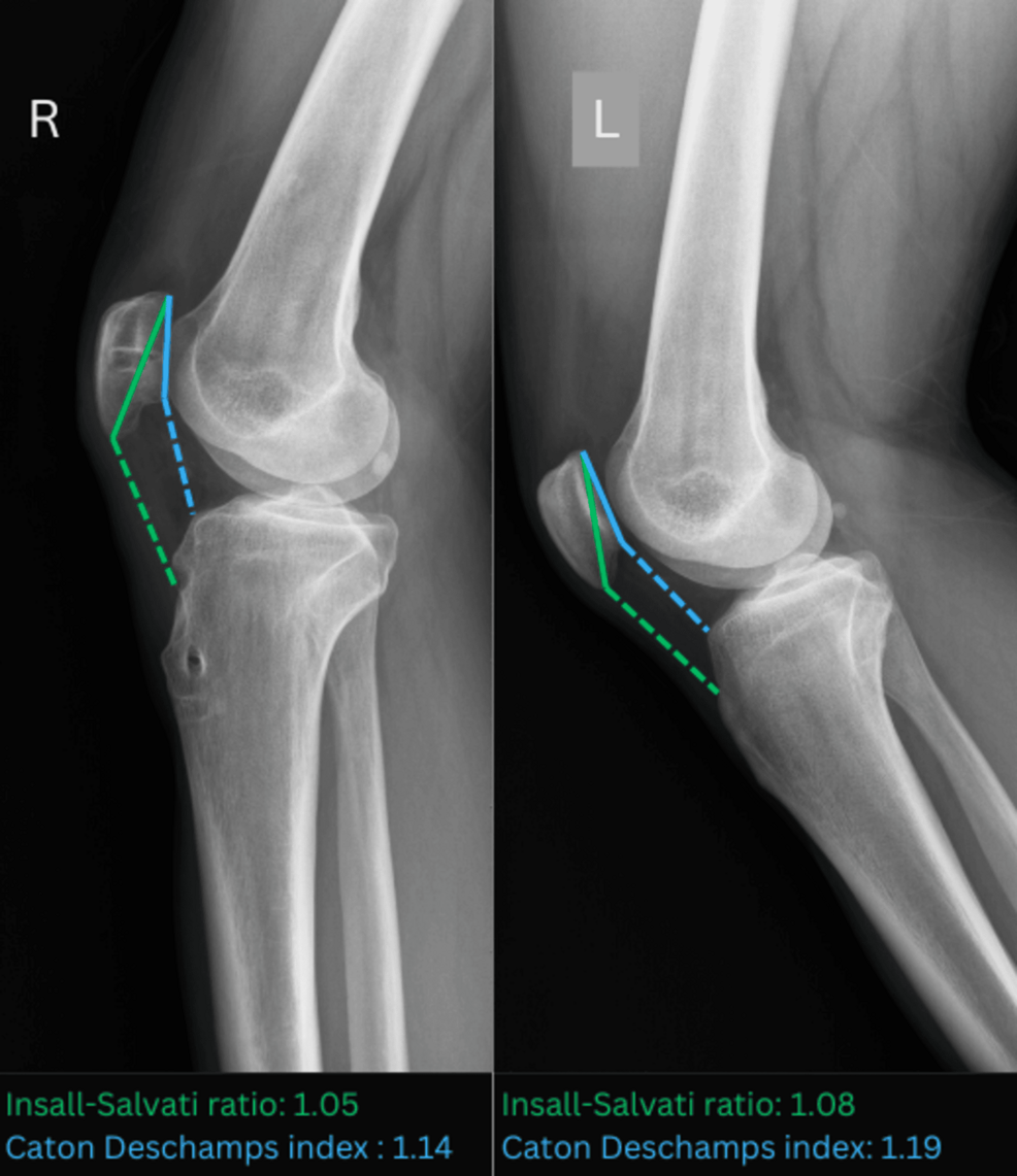 Neglected Patellar Tendon Rupture Treated With a Single Semitendinosus ...