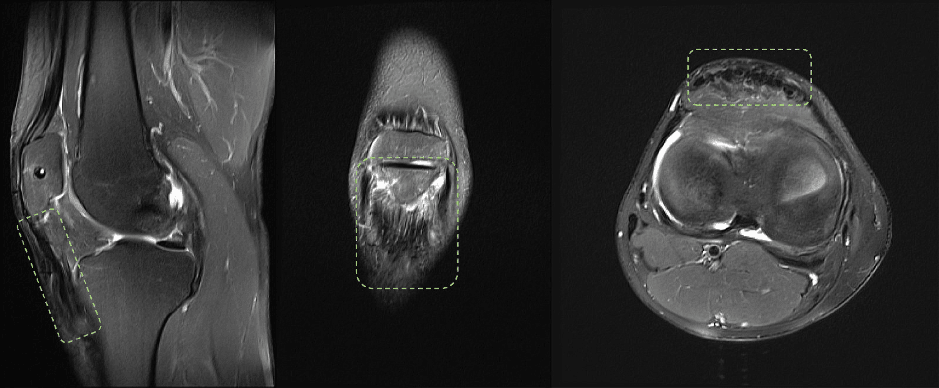 Neglected Patellar Tendon Rupture Treated With a Single Semitendinosus ...