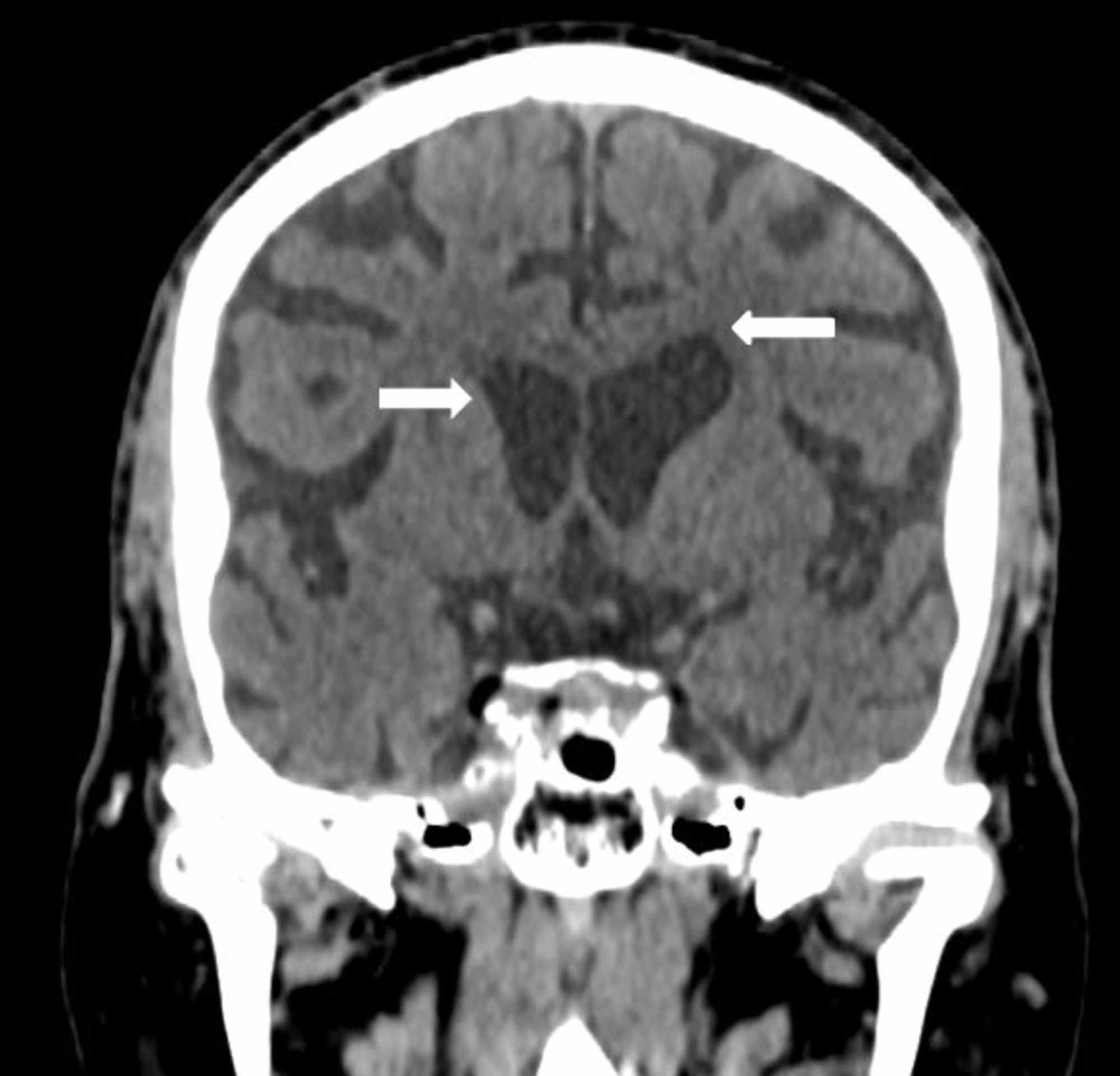 Cureus | Creutzfeldt-Jakob Disease With Atypical Magnetic Resonance ...
