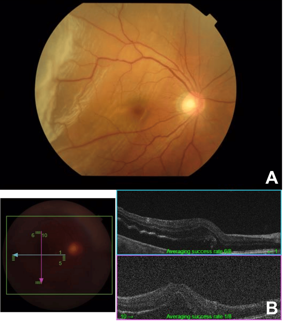 Re-fixation Using the Belt Loop Technique for Postoperative Subluxation ...