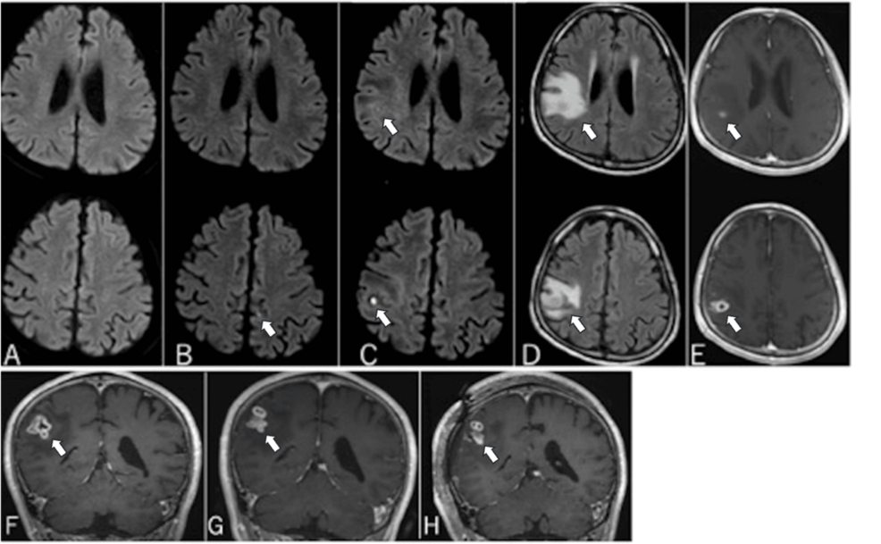 Intracranial Cryptococcoma Mimicking Stroke or Brain Tumor: A ...