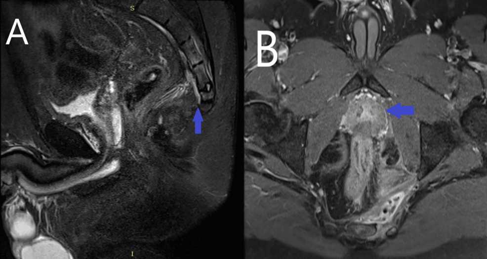 Ischiorectal Abscess Mri