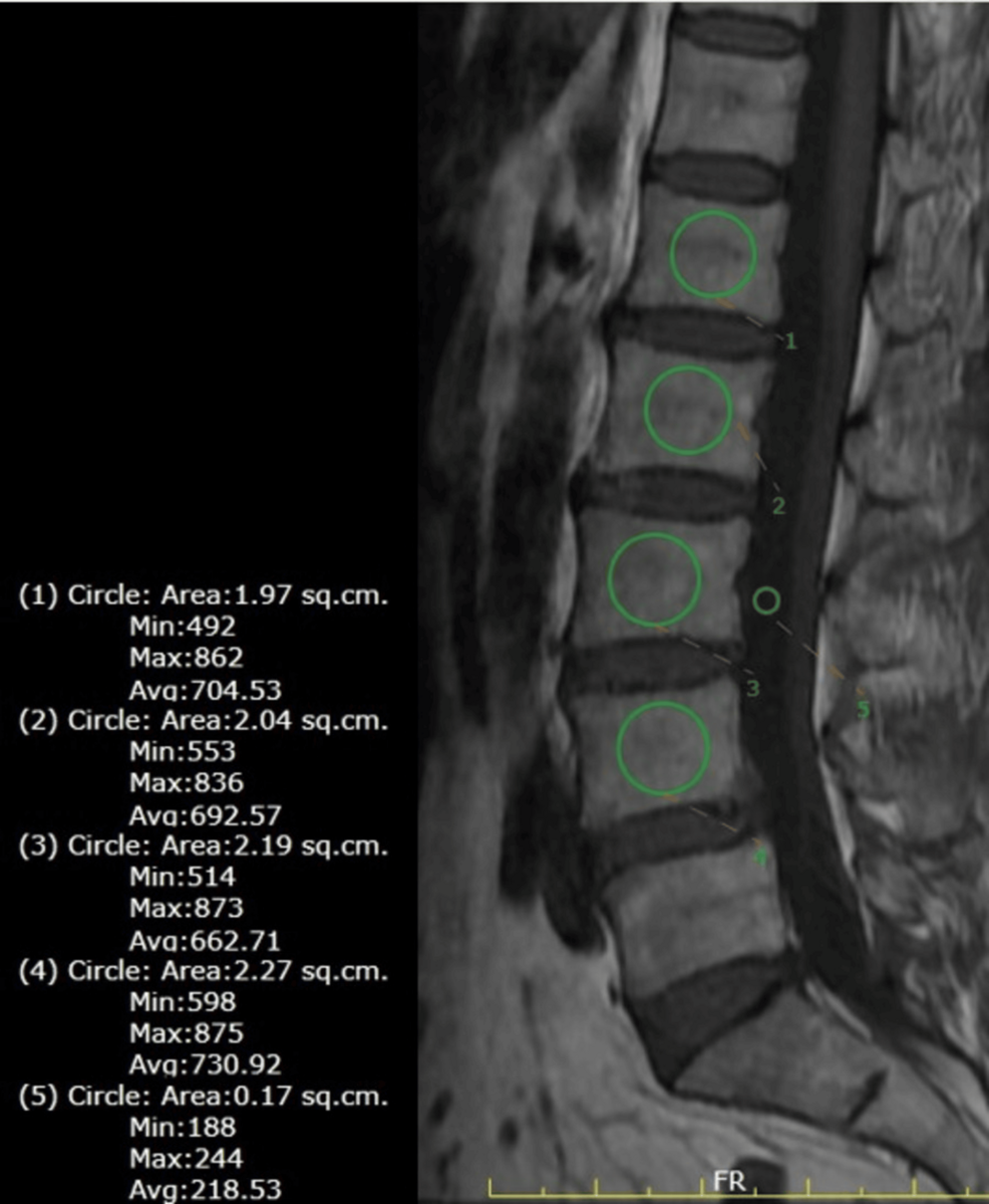Unlocking Osteoporosis Diagnosis: Unveiling the Potential of MRI-Based ...