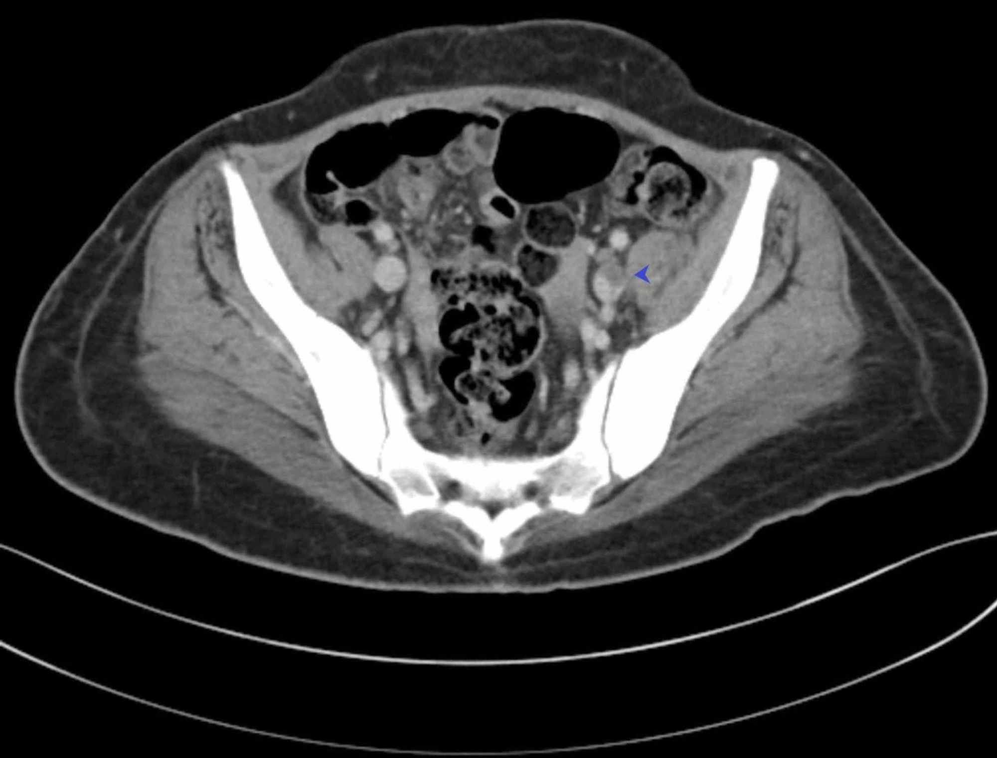 Cureus A Case Of May Thurner Syndrome