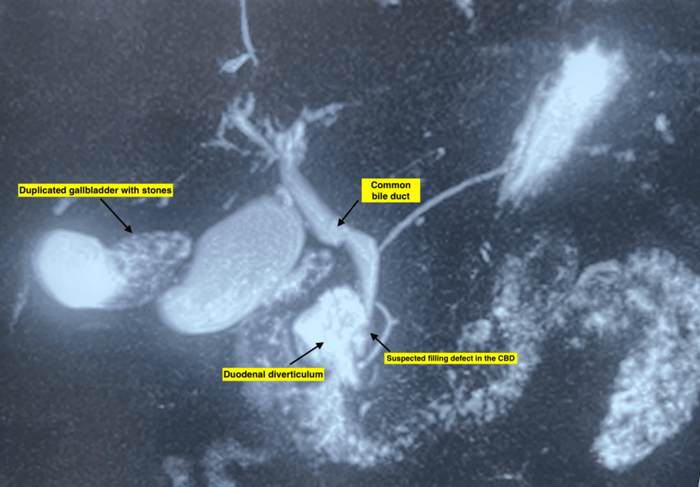 A Case of Jaundice Revealing a Hidden Duo: Lemmel’s Syndrome and a ...