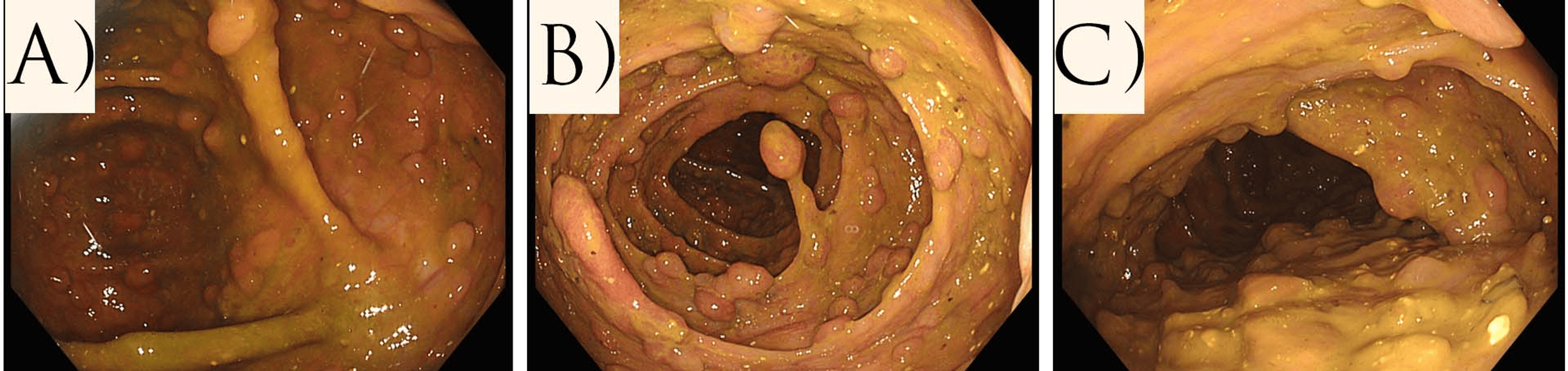 Robot-Assisted Multiquadrant Operation: Proctocolectomy and ...