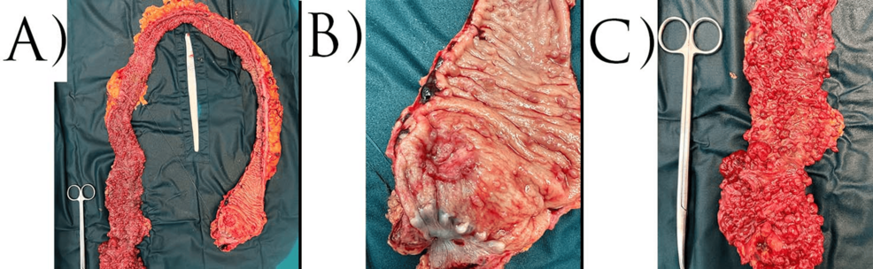 Robot-Assisted Multiquadrant Operation: Proctocolectomy and ...