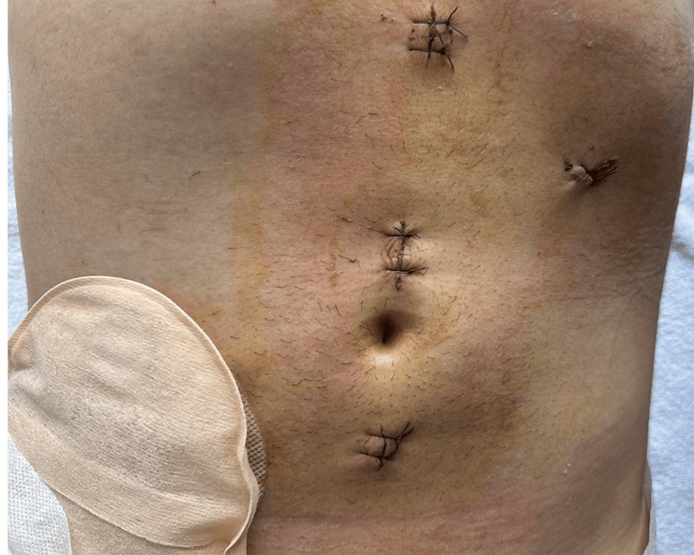 Robot-Assisted Multiquadrant Operation: Proctocolectomy and ...