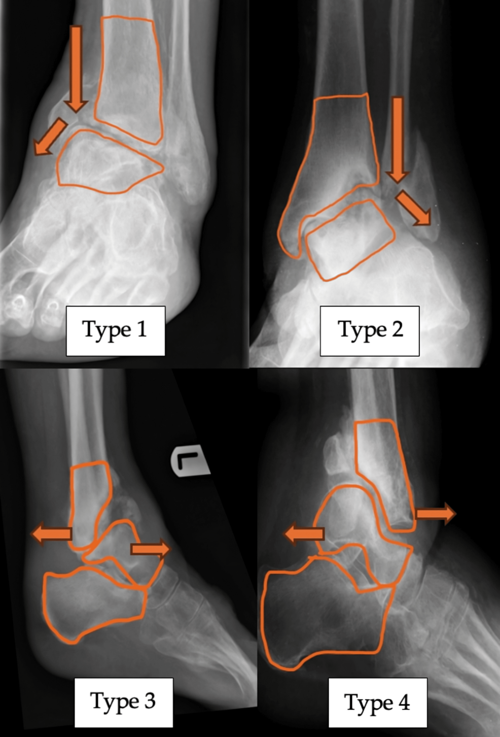 The Manchester Charcot Ankle Neuroarthropathy (M-CAN) Classification: A ...