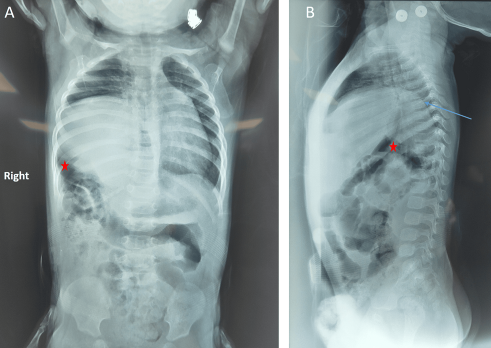 Congenital Diaphragmatic Eventration in an Infant: Diagnostic Pitfalls ...